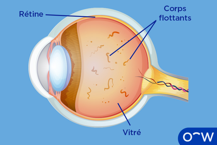 Mouches volantes : Définition, causes, symptômes et traitement