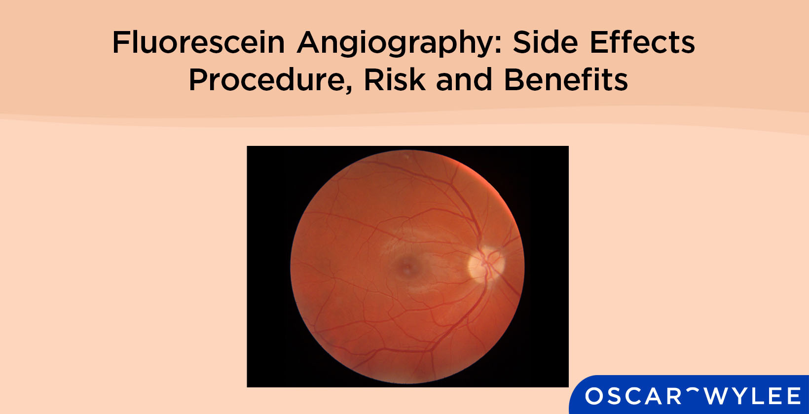 Fluorescein Angiography: Side Effects, Procedure, Risk and Benefits