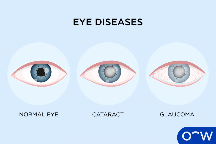 Eye Health Check: 9 Eye Diagnostic Tests
