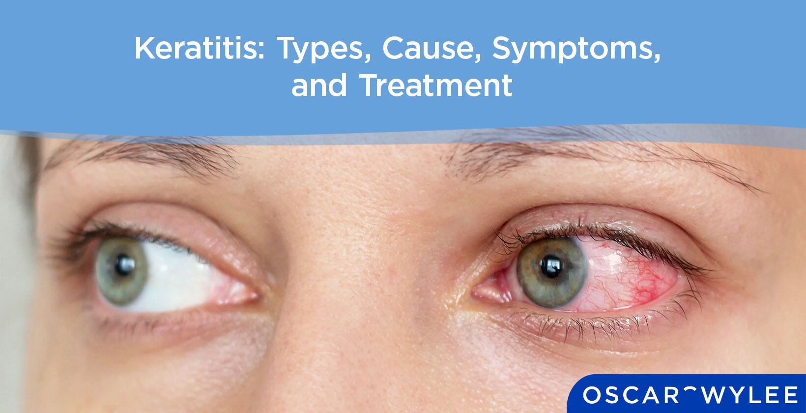 Keratitis: Types, Cause, Symptoms, and Treatment