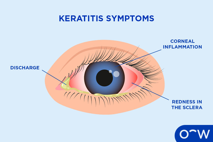 Keratitis: Types, Cause, Symptoms, and Treatment