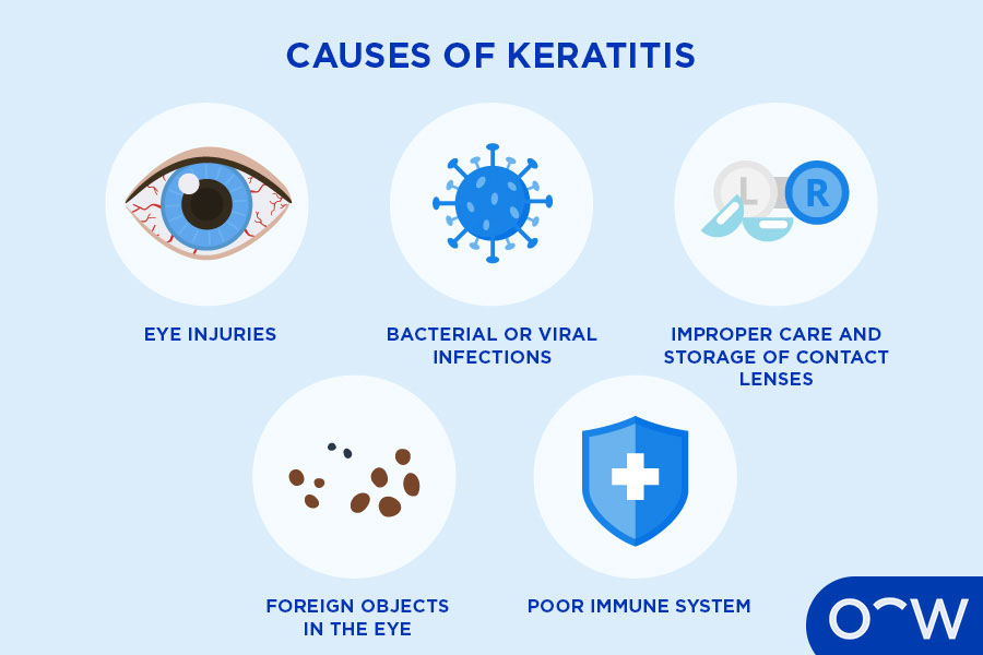 Keratitis: Types, Cause, Symptoms, and Treatment