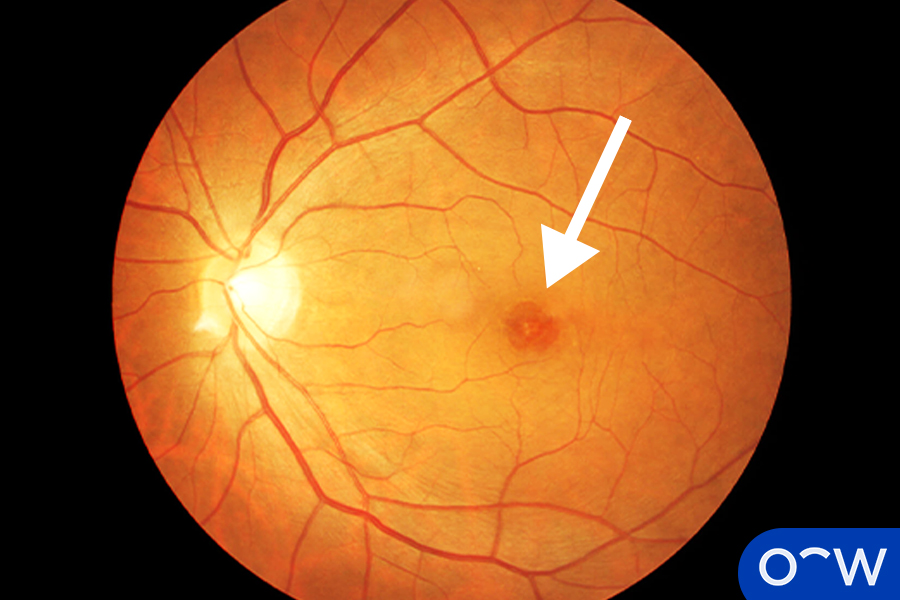Macular Hole in the Eye: Definition, Causes, Symptoms, Diagnosis, and ...