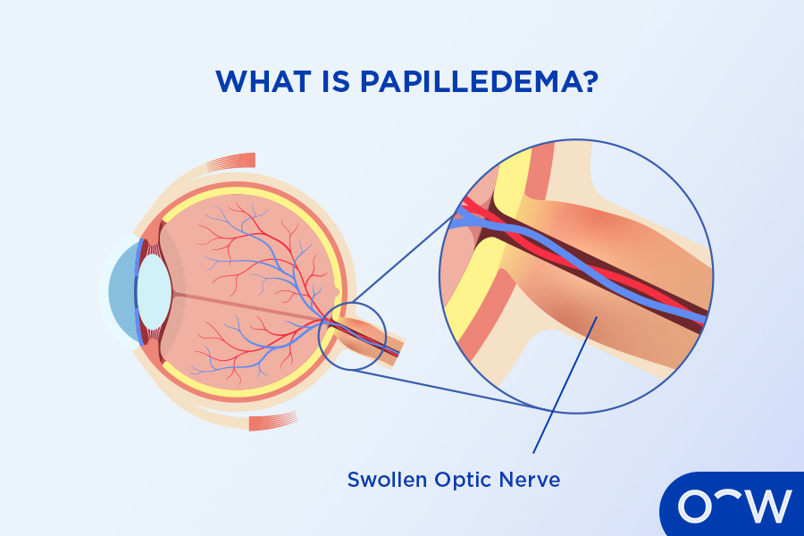 Papilledema: Stages, Symptoms, Causes, Diagnosis, and Treatment
