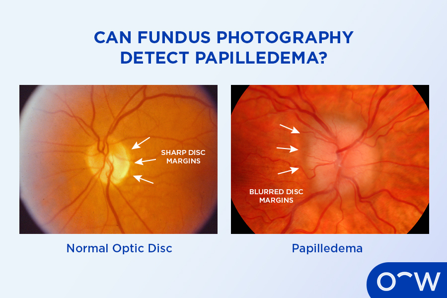 Papilledema: Stages, Symptoms, Causes, Diagnosis, and Treatment