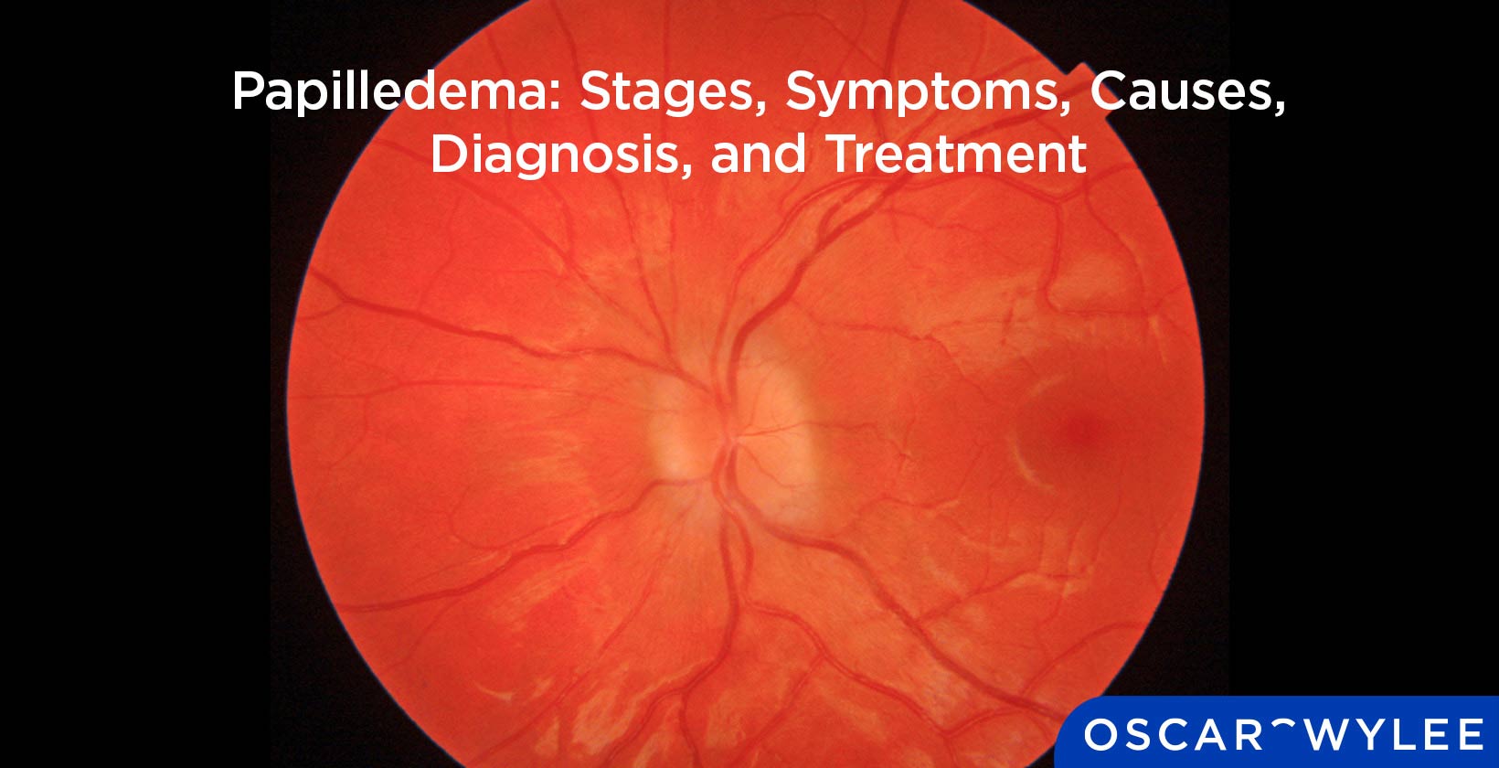 Papilledema: Stages, Symptoms, Causes, Diagnosis, and Treatment