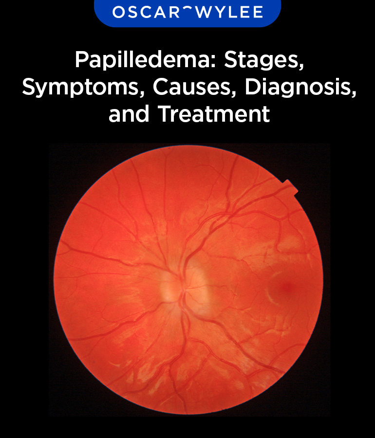 Papilledema: Stages, Symptoms, Causes, Diagnosis, and Treatment