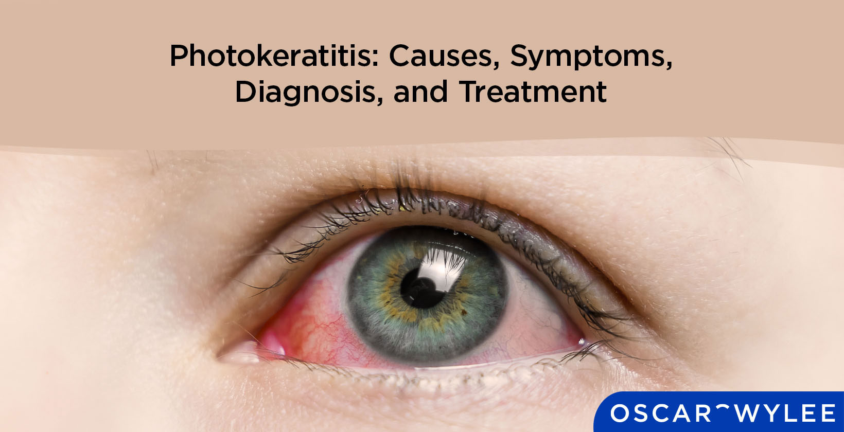 Photokeratitis: Causes, Symptoms, Diagnosis, and Treatment
