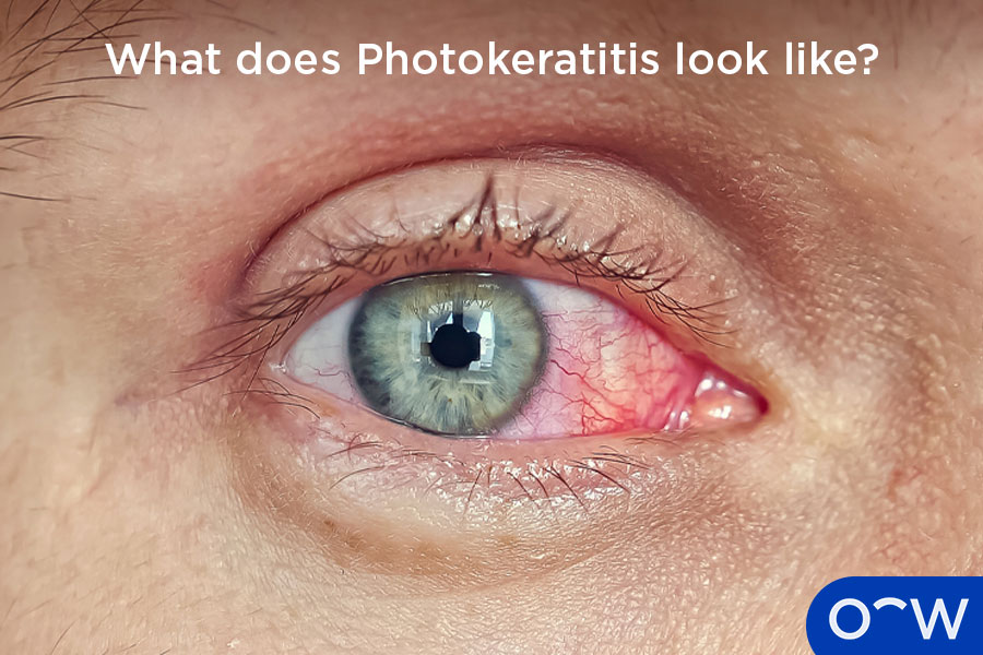 Photokeratitis: Causes, Symptoms, Diagnosis, and Treatment