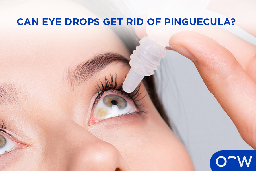 Pinguecula: Causes, Symptoms, Diagnosis, and Treatment