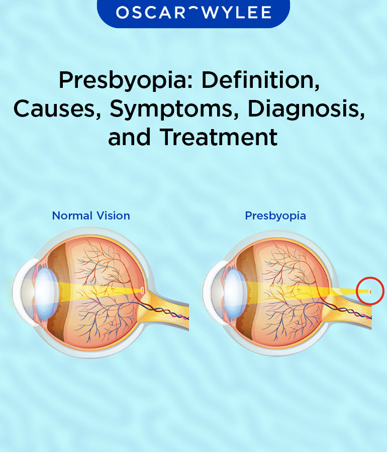 Presbyopia: Definition, Causes, Symptoms, Diagnosis, and Treatment
