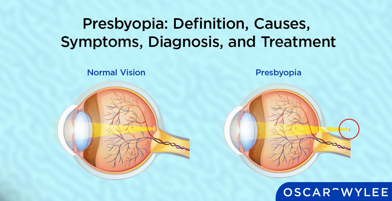 Presbyopia: Definition, Causes, Symptoms, Diagnosis, and Treatment