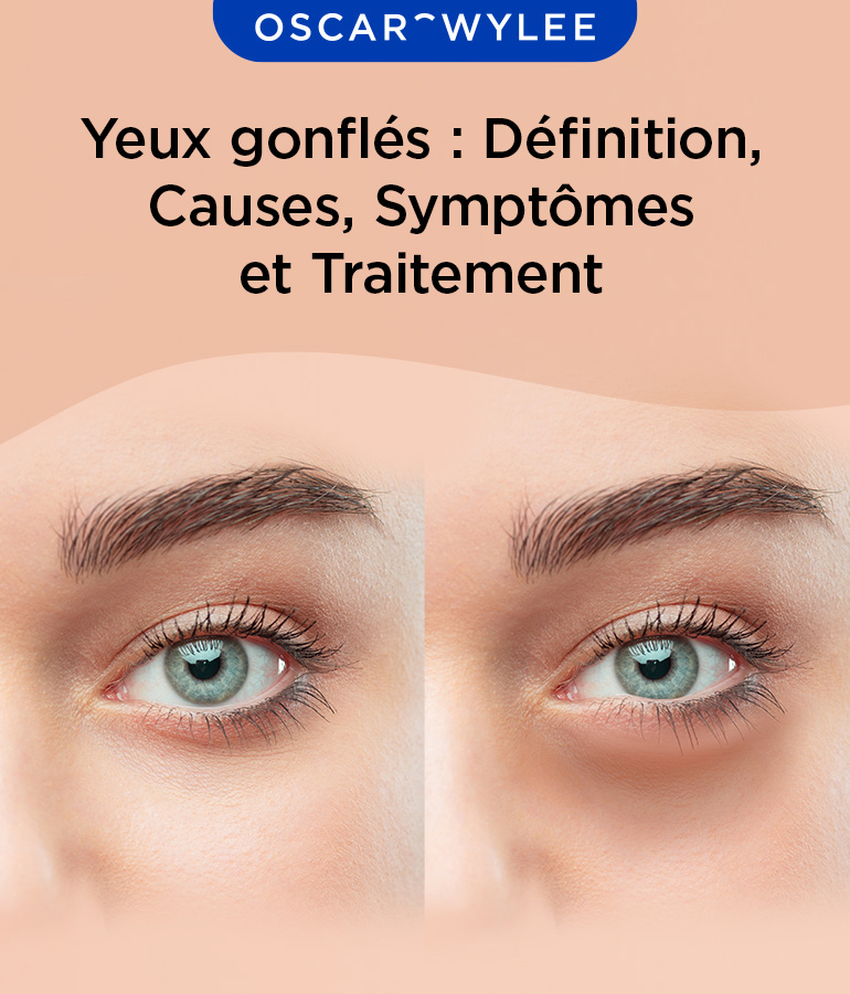 Yeux gonflés : Définition, Causes, Symptômes et Traitement
