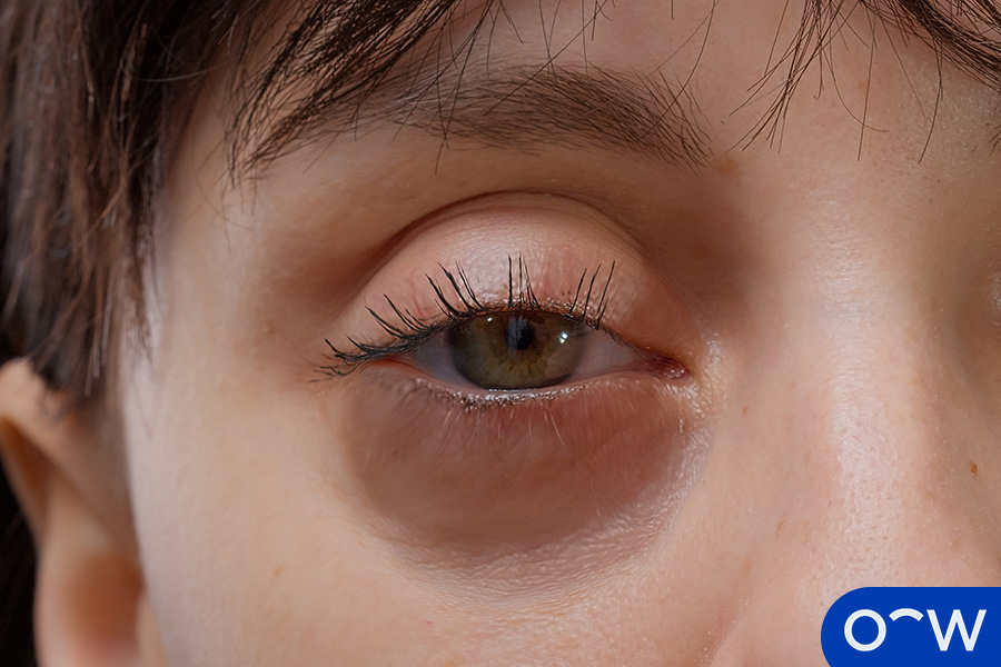 Puffy Eyes: Definition, Causes, Symptoms, and Treatment