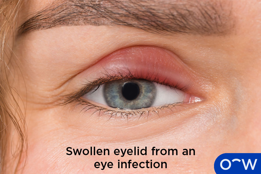 Understanding the Gunk in my Eyes: Causes, Types and Treatments