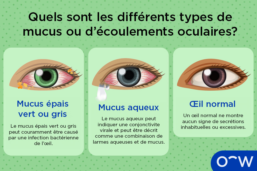 Comprendre les écoulements oculaires : causes, types et traitements