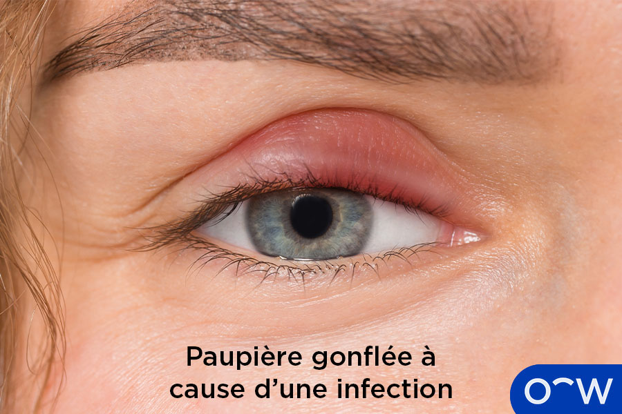 Comprendre les écoulements oculaires : causes, types et traitements