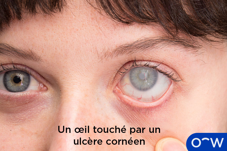 Comprendre les écoulements oculaires : causes, types et traitements