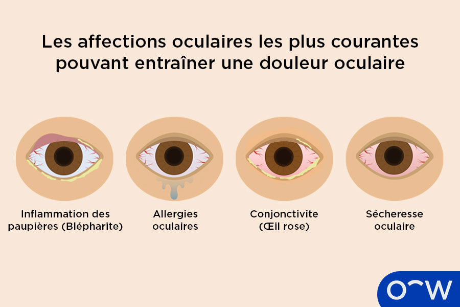 Pourquoi j’ai mal aux yeux lorsque je me réveille ? 8 causes et leurs ...