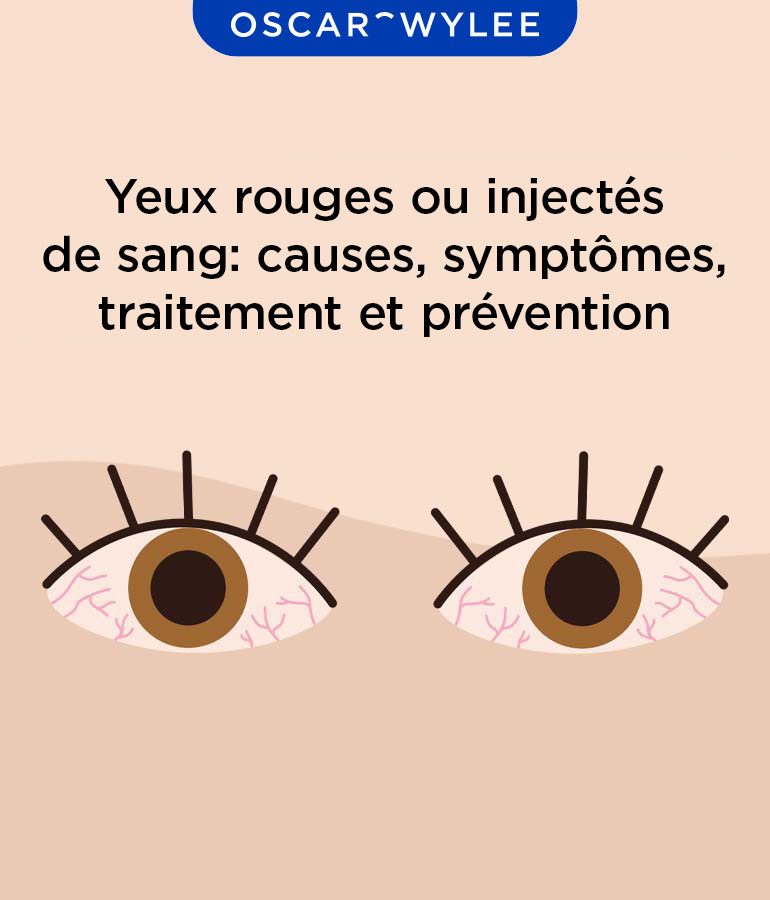 Les yeux rouges ou injectés de sang : causes, symptômes, traitement et ...