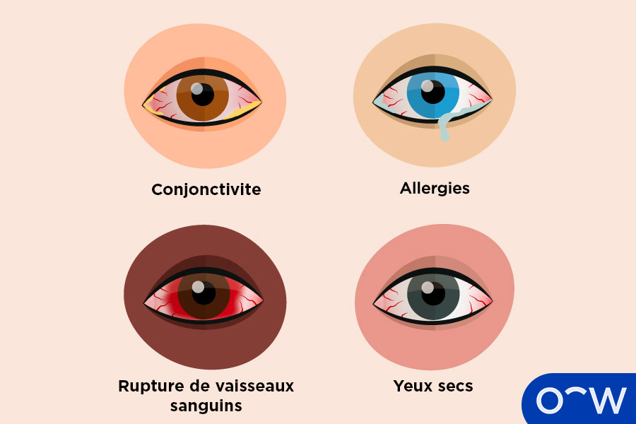 Les yeux rouges ou injectés de sang : causes, symptômes, traitement et ...