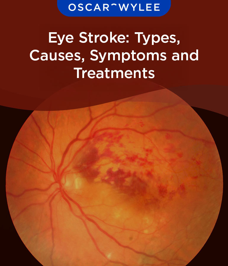 Eye Stroke: Types, Symptoms, and Risk Factors