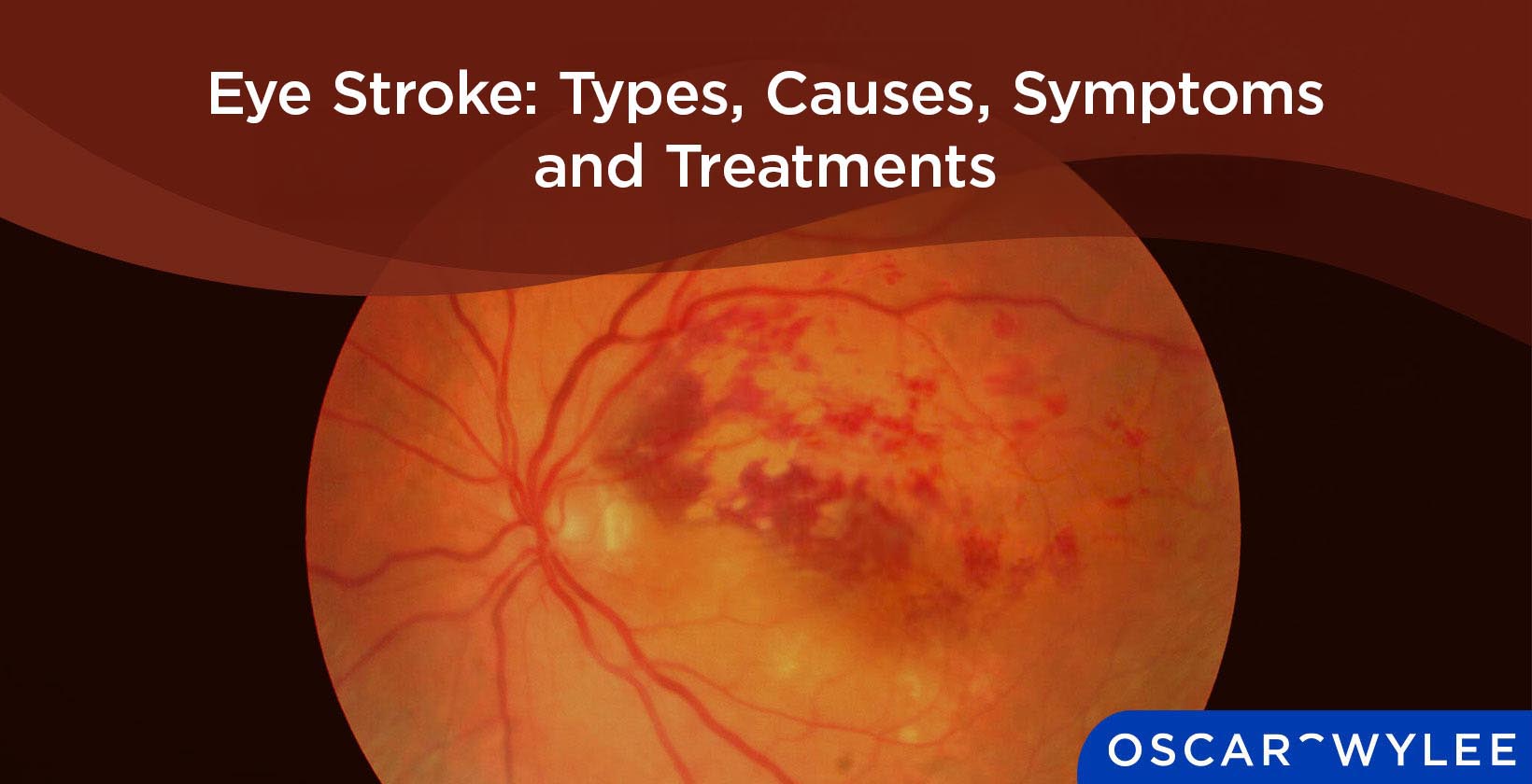 Eye Stroke: Types, Symptoms, and Risk Factors