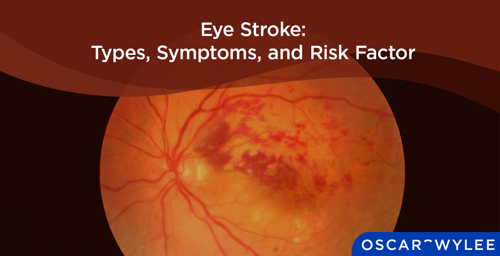 Eye Stroke: Types, Symptoms, and Risk Factors