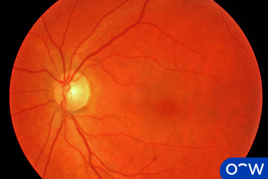Eye Stroke: Types, Symptoms, and Risk Factors