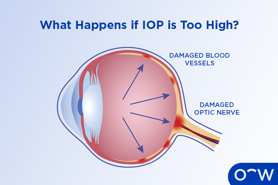 Tonometry Test: Importance, Procedure, Types and Results