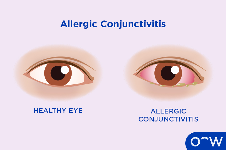 Watery Eyes: Causes, Tests, Symptoms, Treatment and Prevention