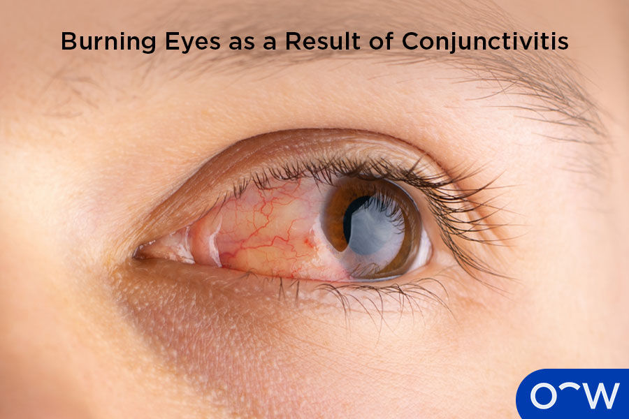 What to Do If You Burn Your Eye: Immediate Actions and Treatment